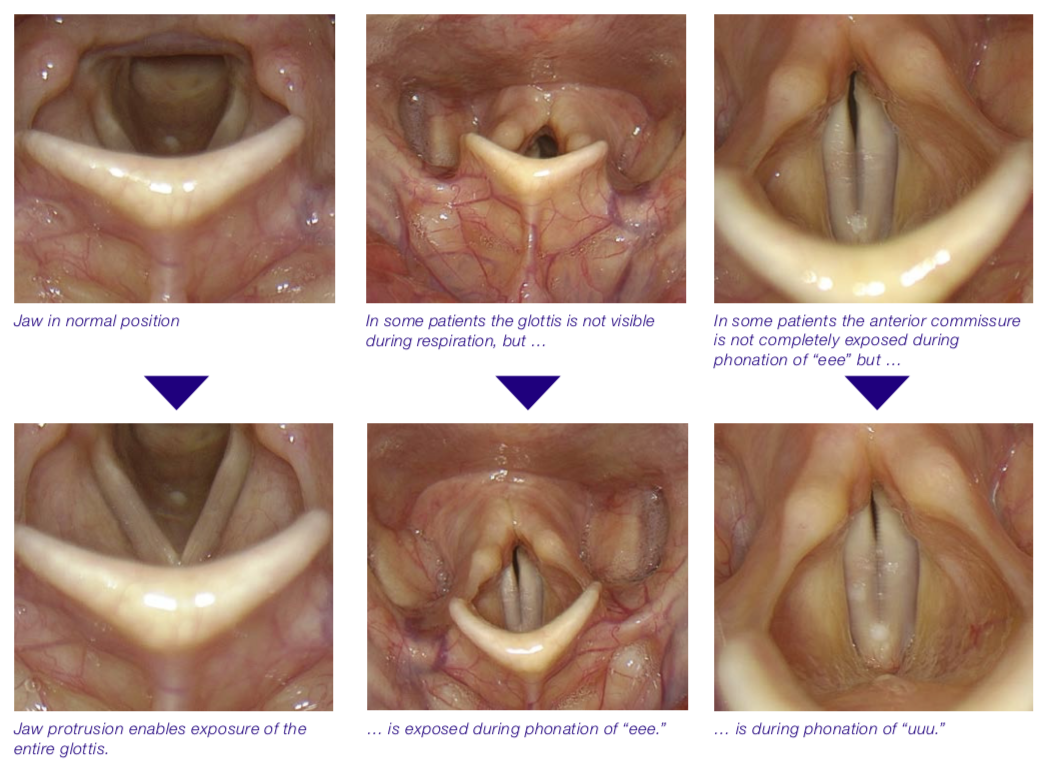Office-Based Laryngoscopy Good Practicing Laryngoscopy Part3 - Olympus ...