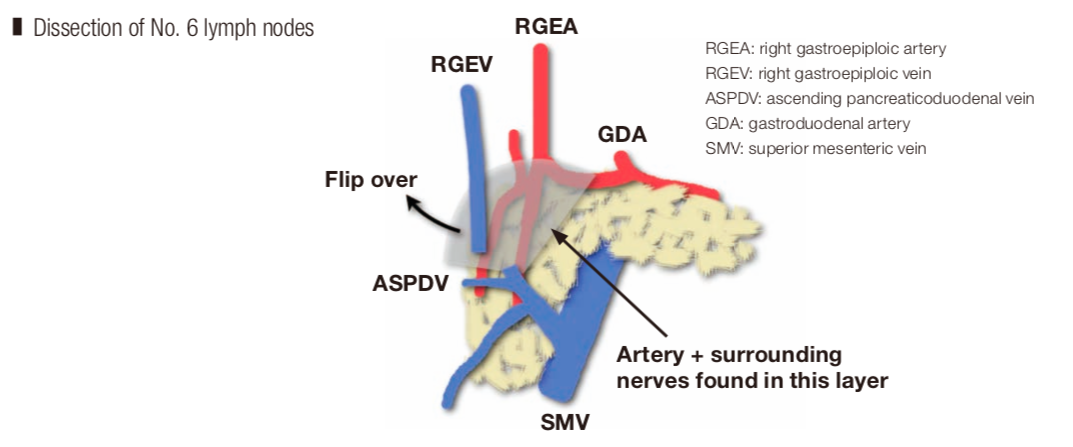 Performed with THUNDERBEAT Laparoscopic distal gastrectomy D2 lymph ...
