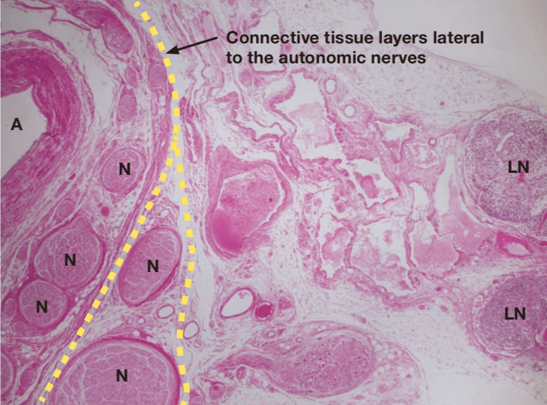 Performed with THUNDERBEAT Laparoscopic distal gastrectomy D2 lymph ...