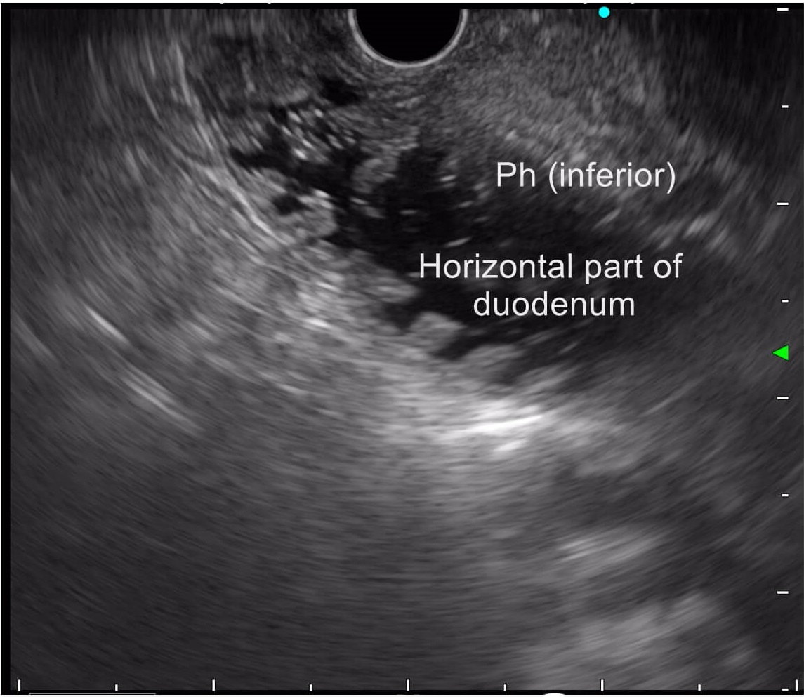 Standard Imaging Methods Using a Convex Ultrasonic Endoscope for EUS ...