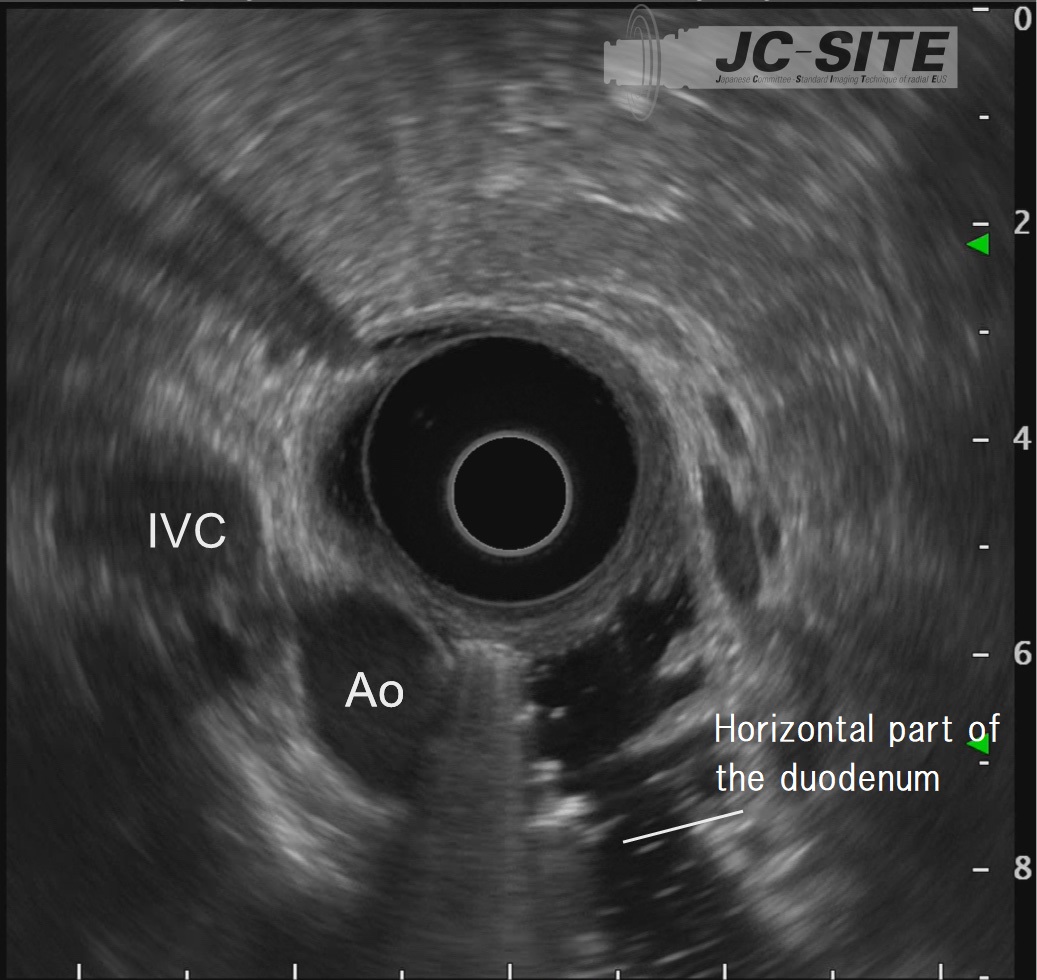 Standard Imaging Methods in the Pancreatobiliary Region Using Radial ...