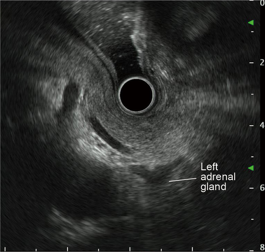 Standard Imaging Methods in the Pancreatobiliary Region Using Radial ...