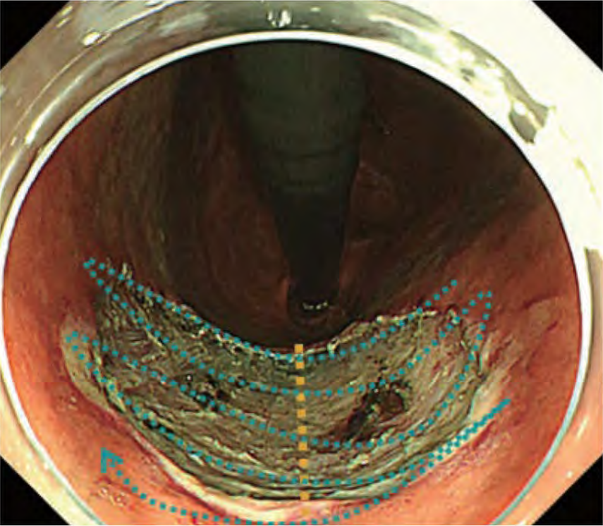 Basic operation and techniques for Endoscopic Hand-Suturing with ...