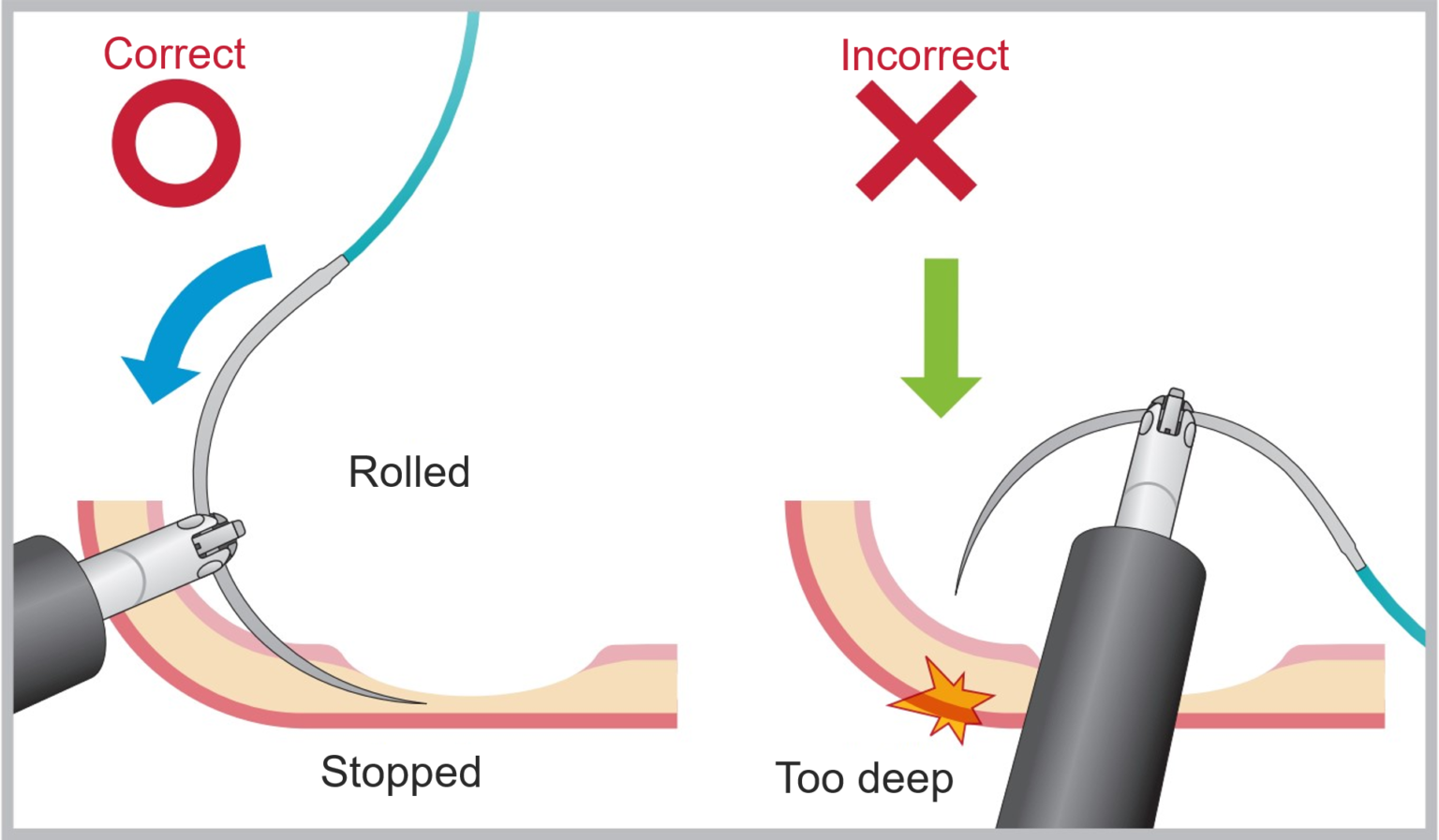 Basic operation and techniques for Endoscopic Hand-Suturing with ...