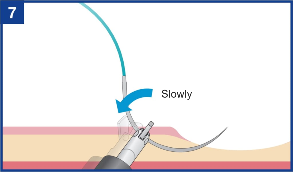 Basic operation and techniques for Endoscopic Hand-Suturing with ...