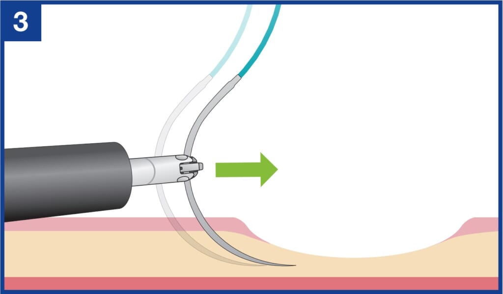 Basic operation and techniques for Endoscopic Hand-Suturing with ...