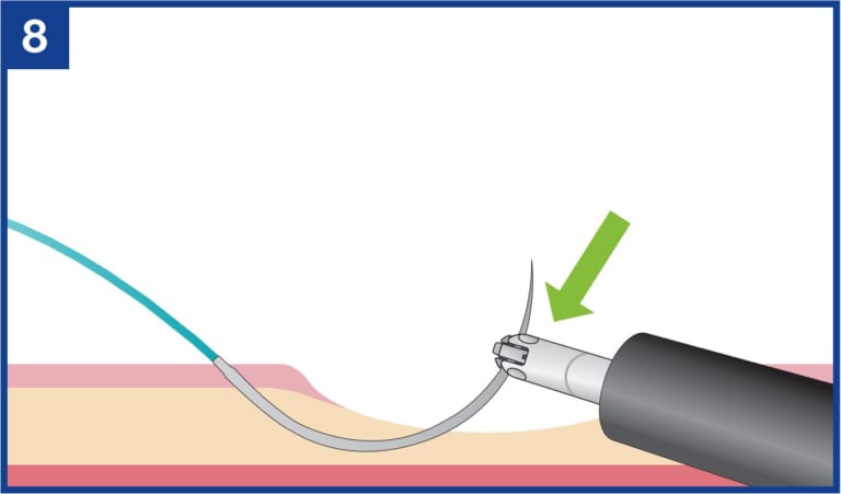 Basic operation and techniques for Endoscopic Hand-Suturing with ...