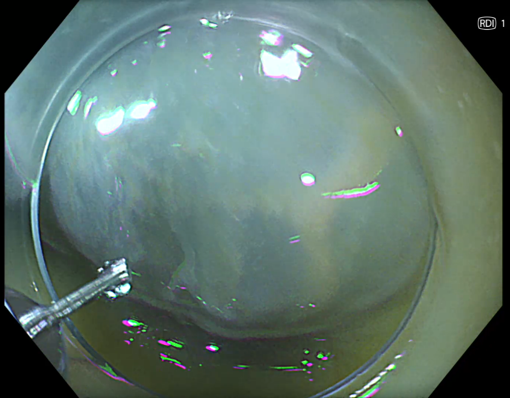 Esophageal Cases - Olympus Professional Education On-Demand Library
