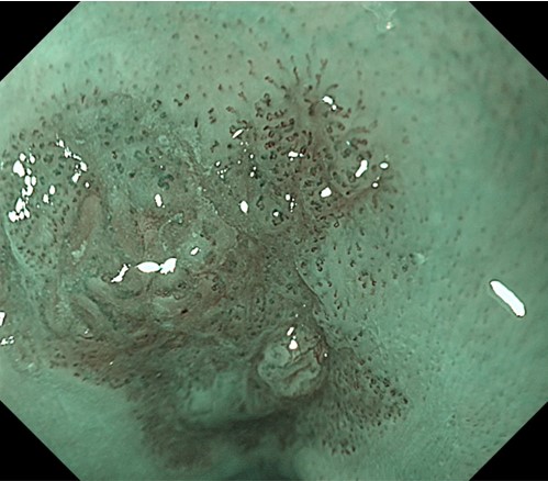 Esophageal Cases - Olympus Professional Education On-Demand Library
