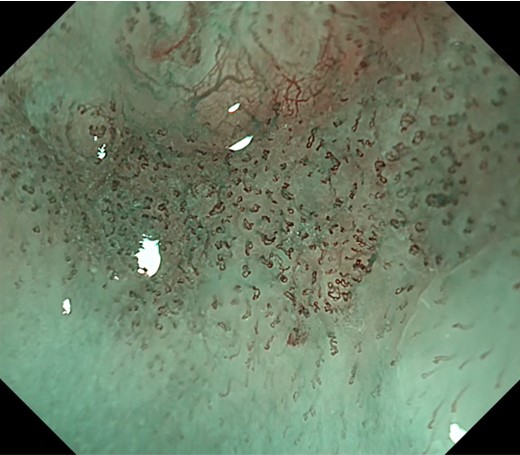 Esophageal Cases - Olympus Professional Education On-Demand Library