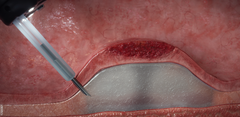 EndoClot® Submucosal Injection Solution (SIS) - Olympus Professional ...