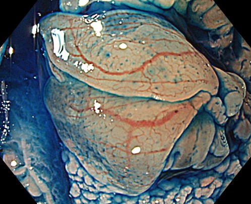 Colorectal Cases - Olympus Professional Education On-Demand Library