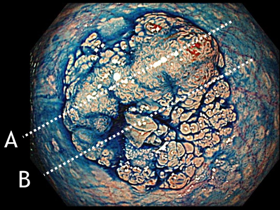 Colorectal Cases - Olympus Professional Education On-Demand Library