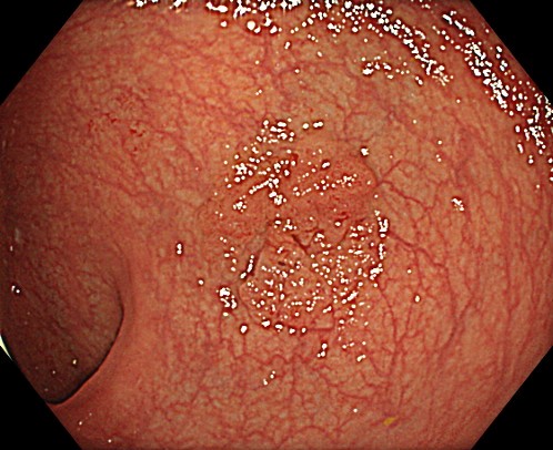 Colorectal Cases - Olympus Professional Education On-Demand Library