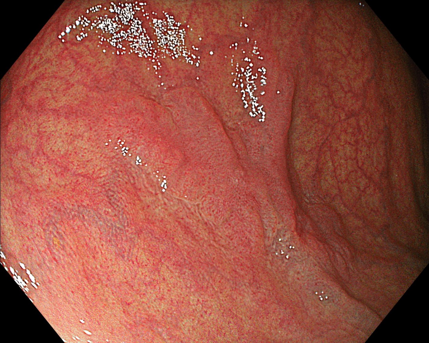 Colorectal Cases - Olympus Professional Education On-Demand Library