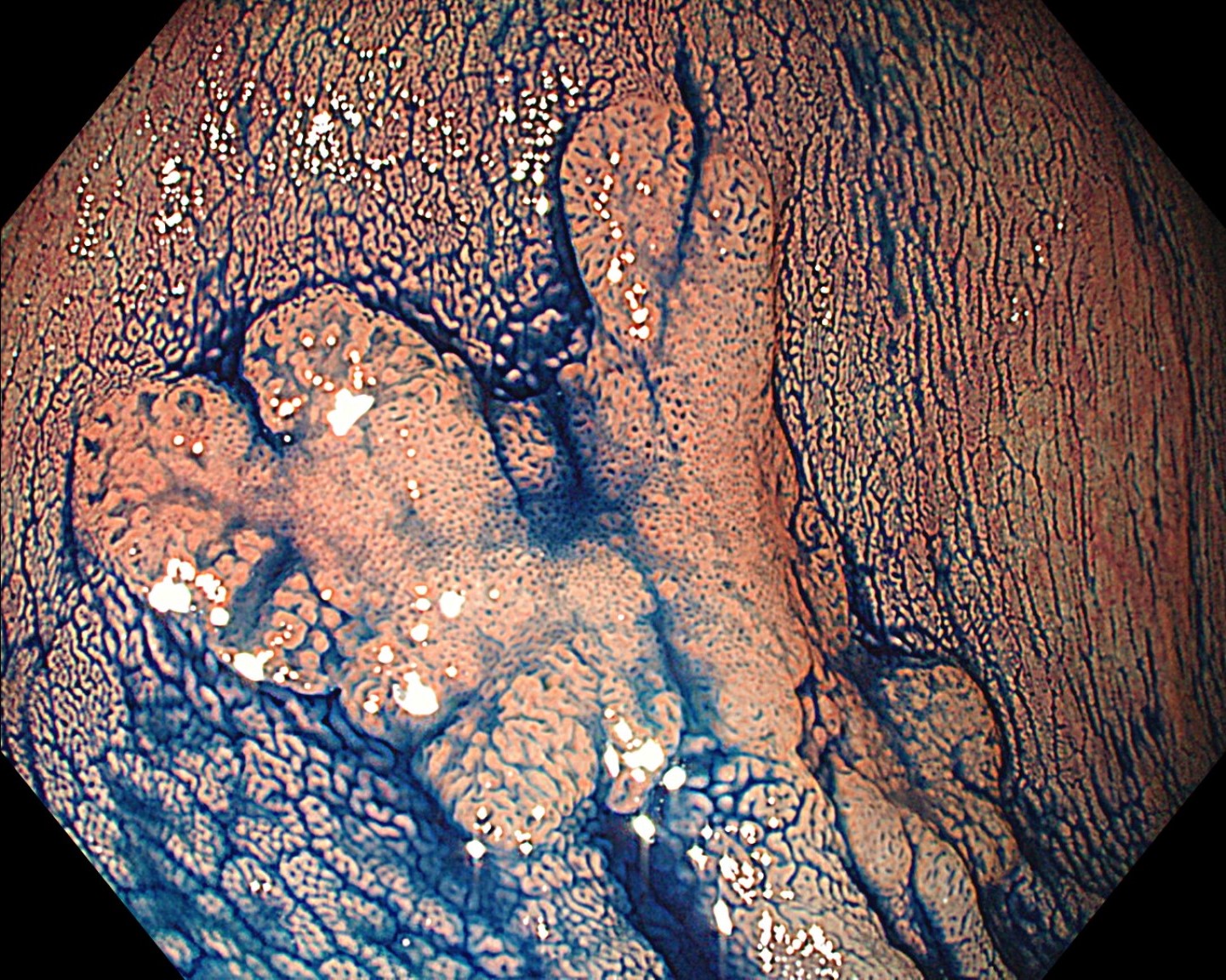 Colorectal Cases - Olympus Professional Education On-Demand Library