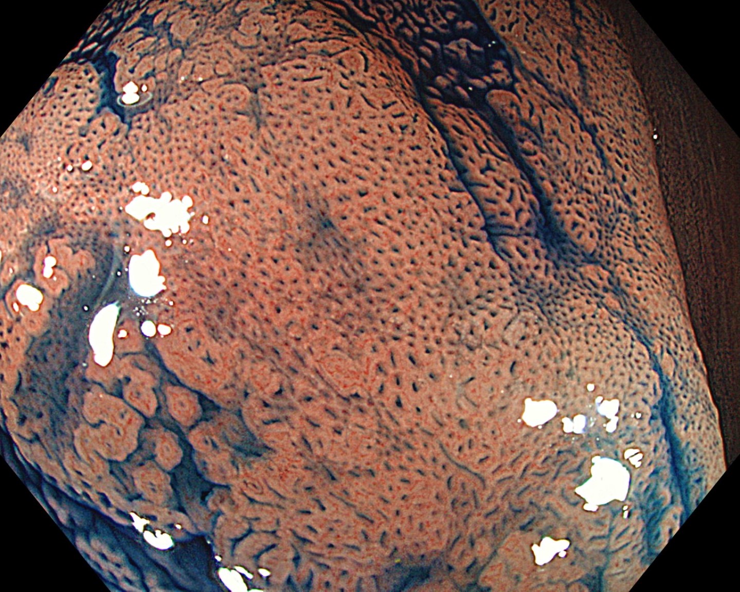 Colorectal Cases - Olympus Professional Education On-Demand Library