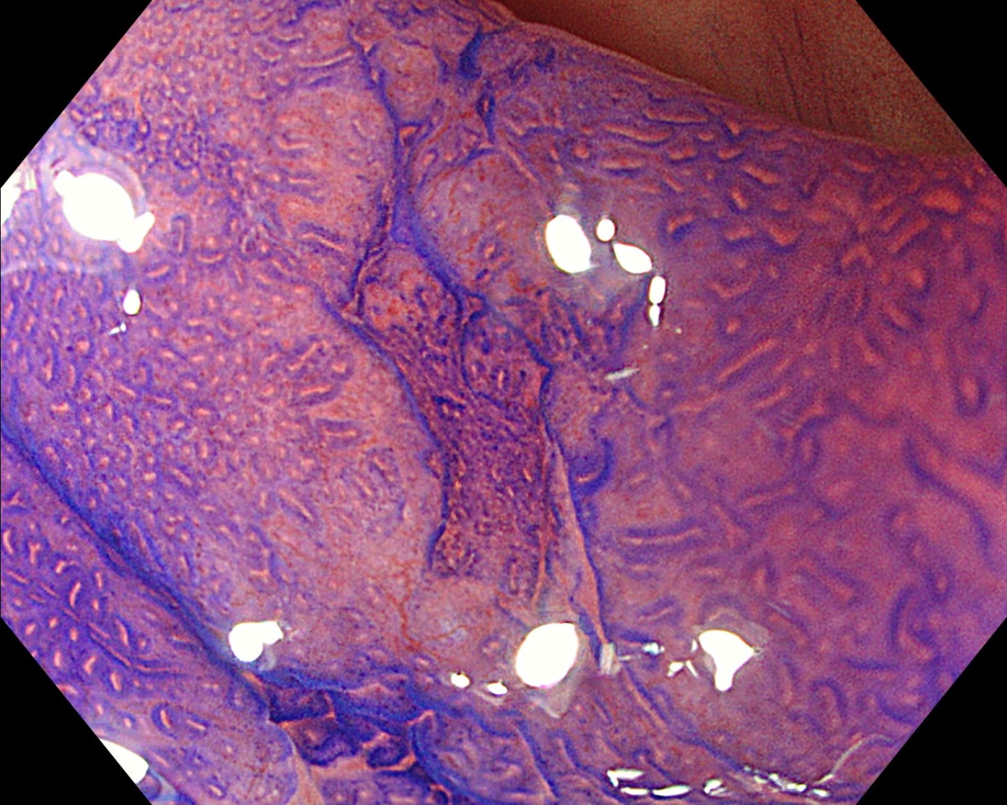 Colorectal Cases - Olympus Professional Education On-Demand Library